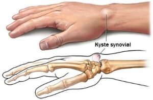Exérèse de kyste synovial - Main chirurgie